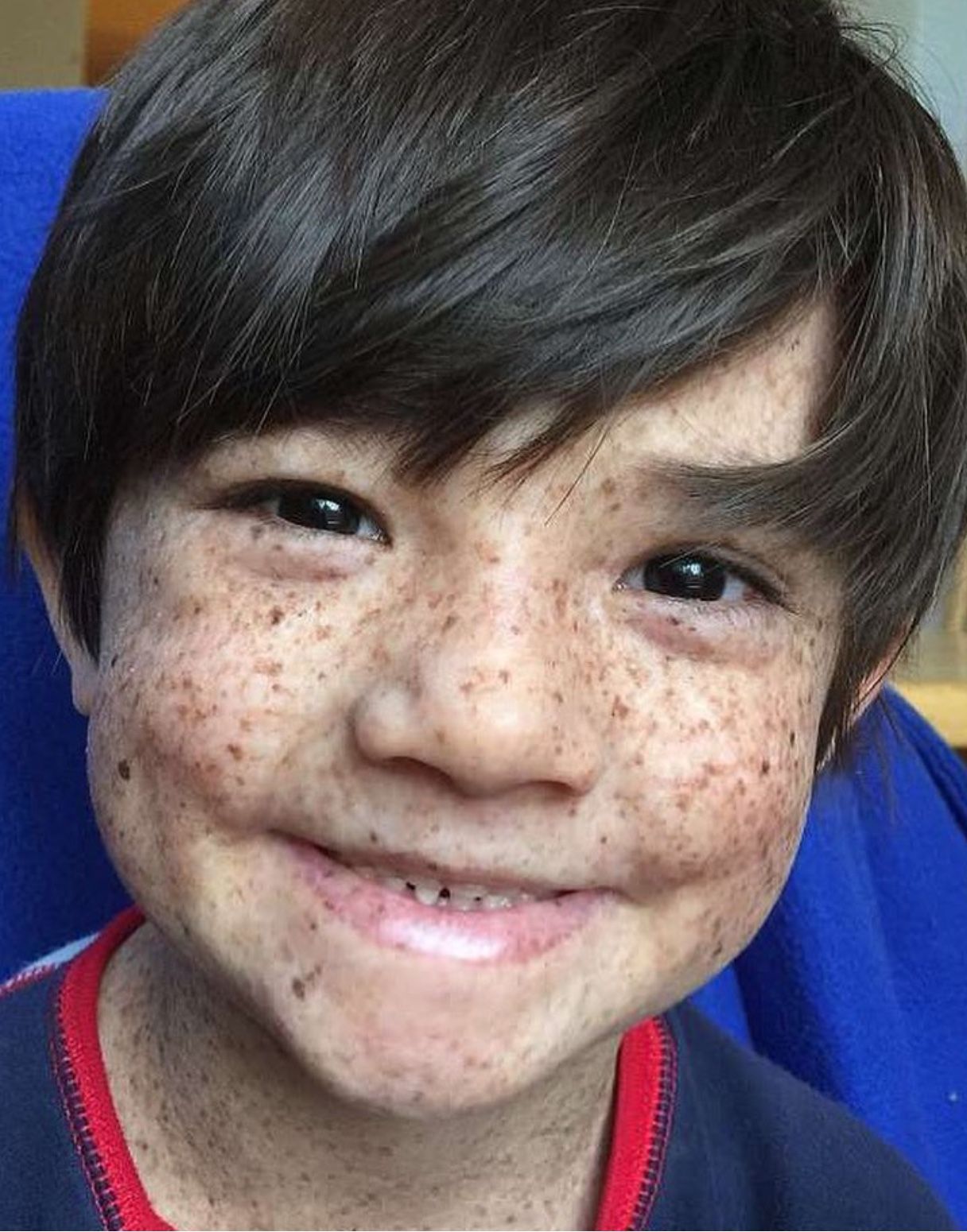 O que é Xeroderma ? - Momento Saúde